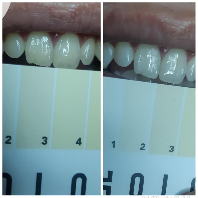 Holo Teeth Whitening Kit
