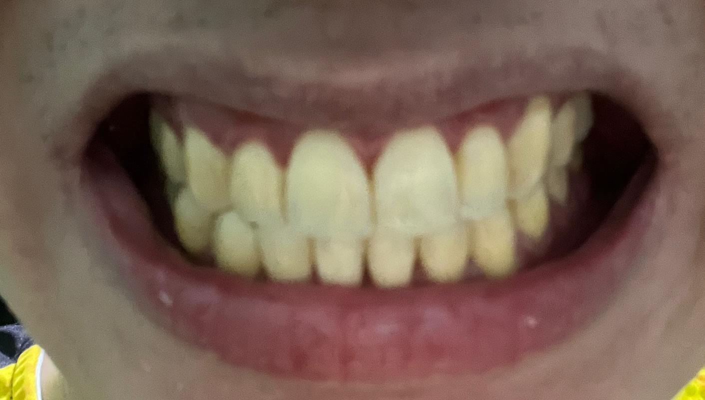 Holo Teeth Whitening Kit