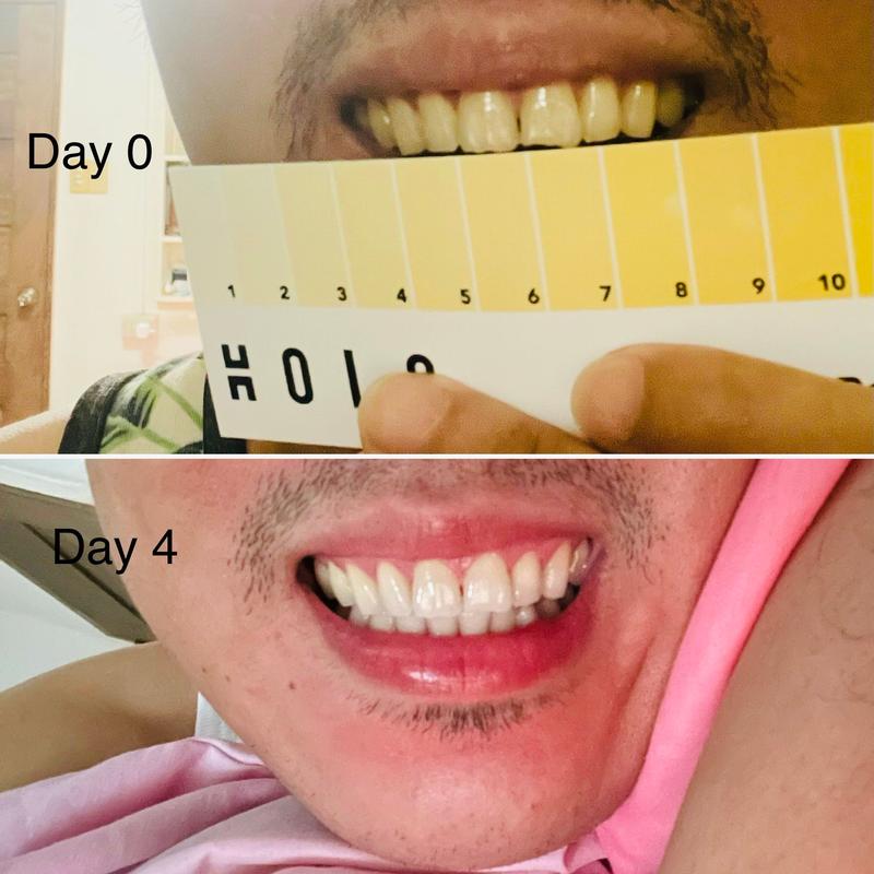 Holo Teeth Whitening Kit