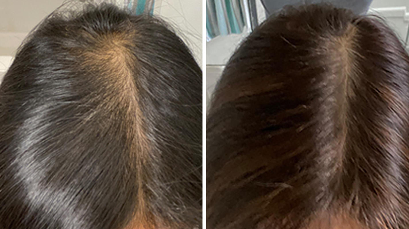 Irestore Professional Laser Hair Growth System Fda Cleared