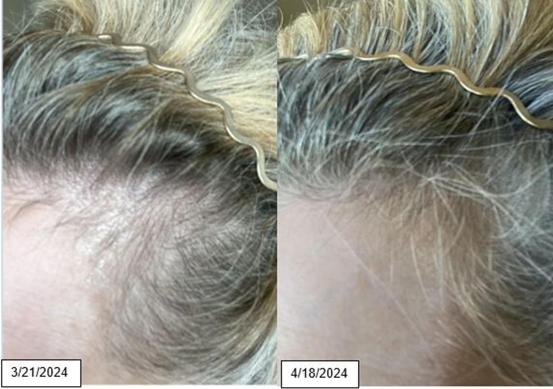 iRESTORE Elite – World’s Best Hair Growth Laser Device | FDA Cleared ...