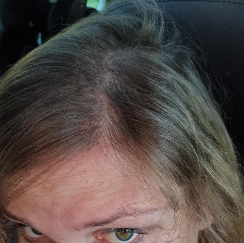 iRESTORE Elite – World’s Best Hair Growth Laser Device | FDA Cleared ...