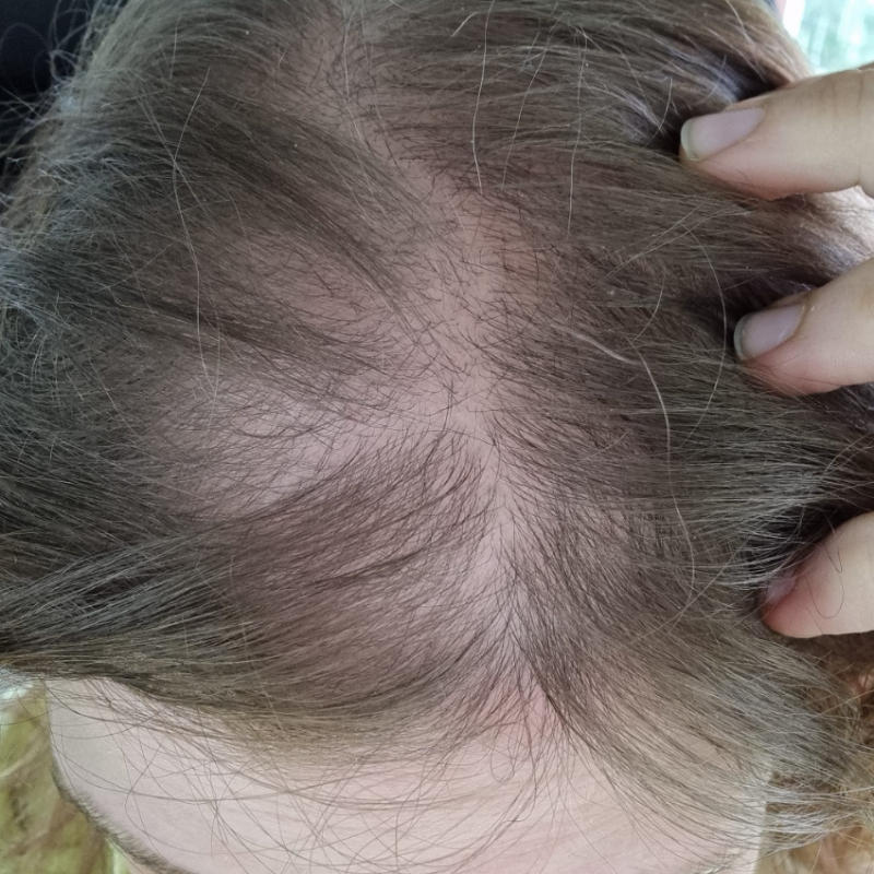 iRESTORE Professional – Best Selling Hair Growth Device | FDA Cleared ...