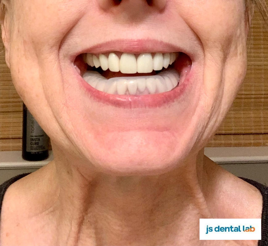 Semi-Hard Mouth Guard for Teeth Clenching | JS Dental Lab