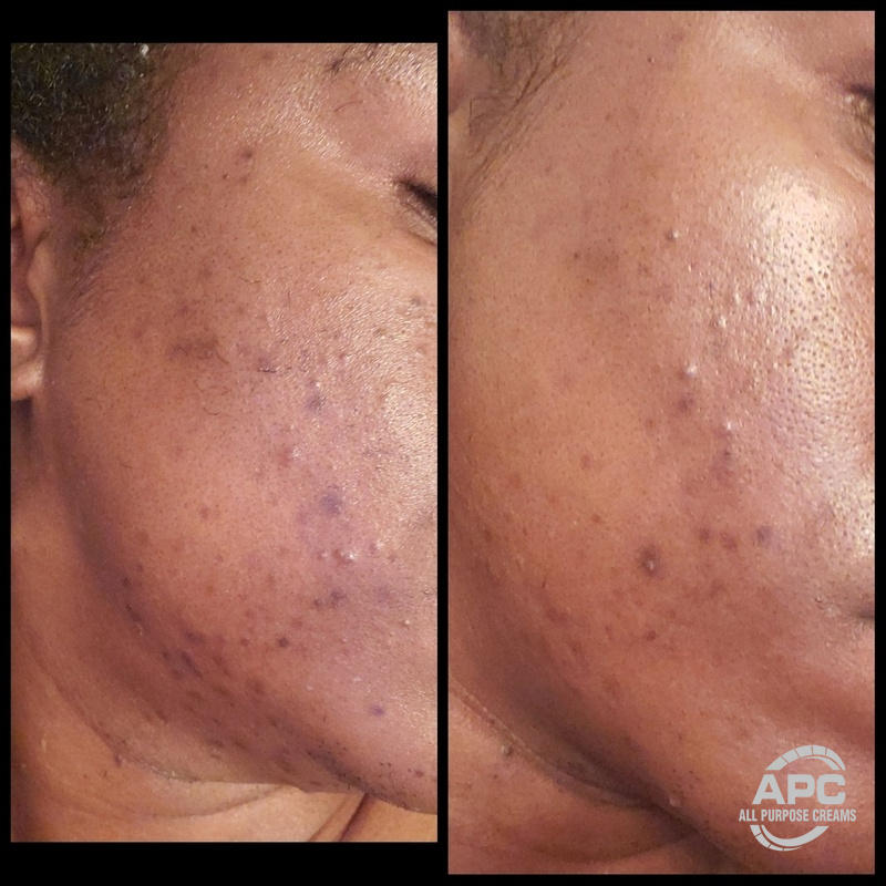 5% Cysteamine Cream - Only Target Hyperpigmentation – All Purpose Creams