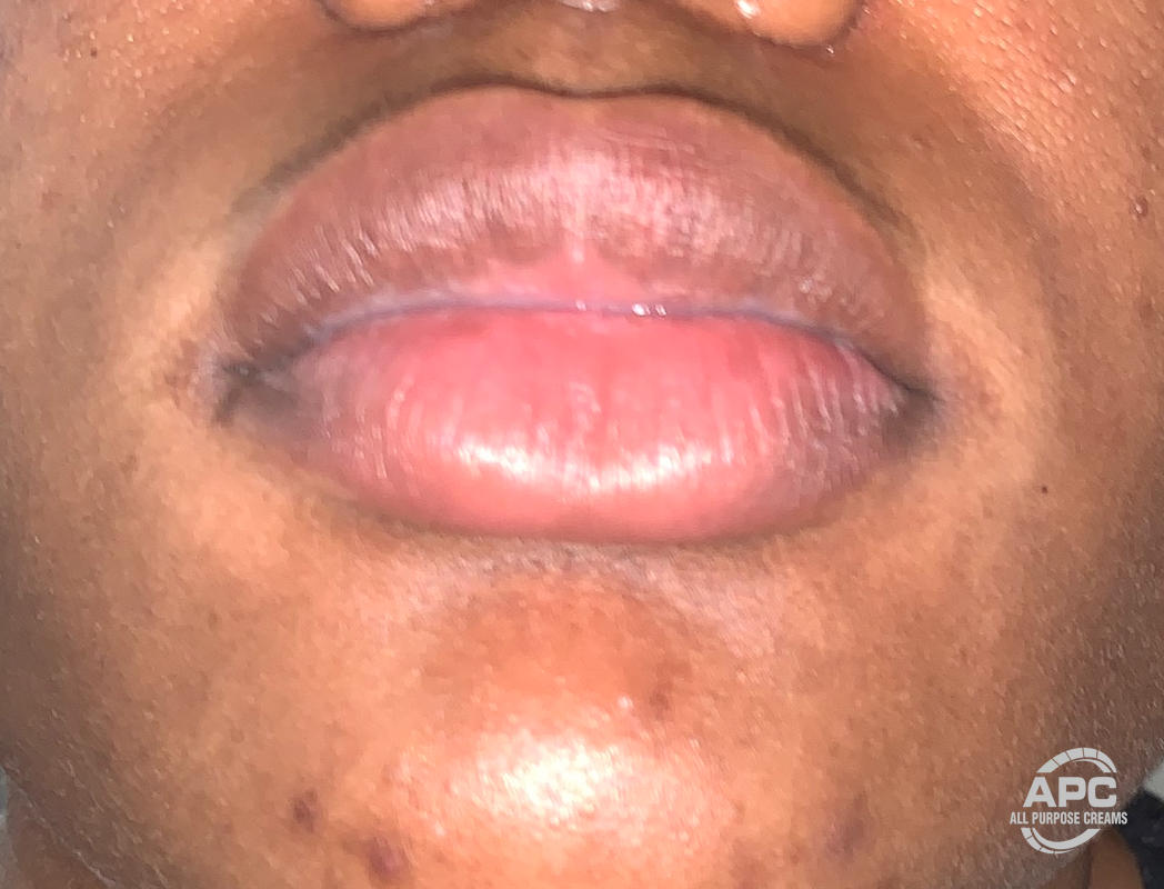 5% Cysteamine Cream - Only Target Hyperpigmentation – All Purpose Creams