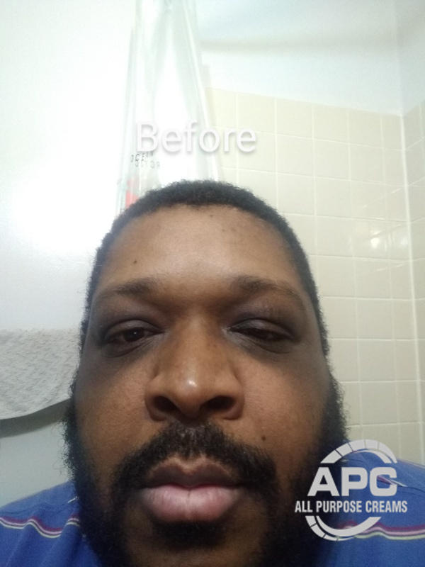 All Purpose Hydroquinone - Since 2017 – All Purpose Creams