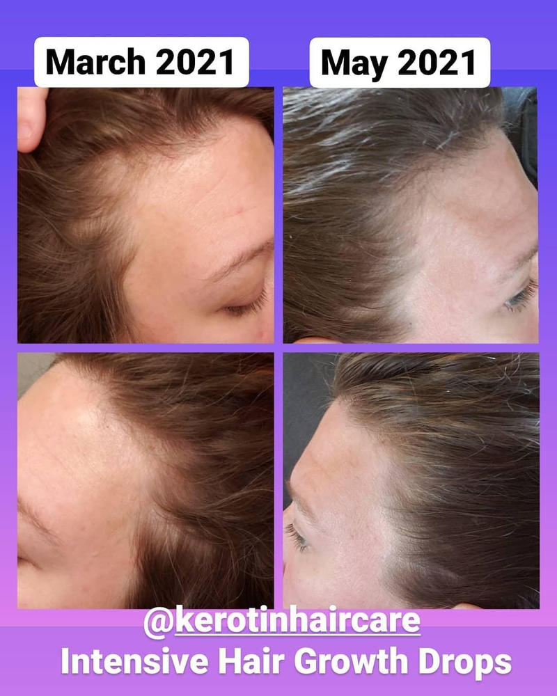 Intensive Hair Growth Drops – Kerotin